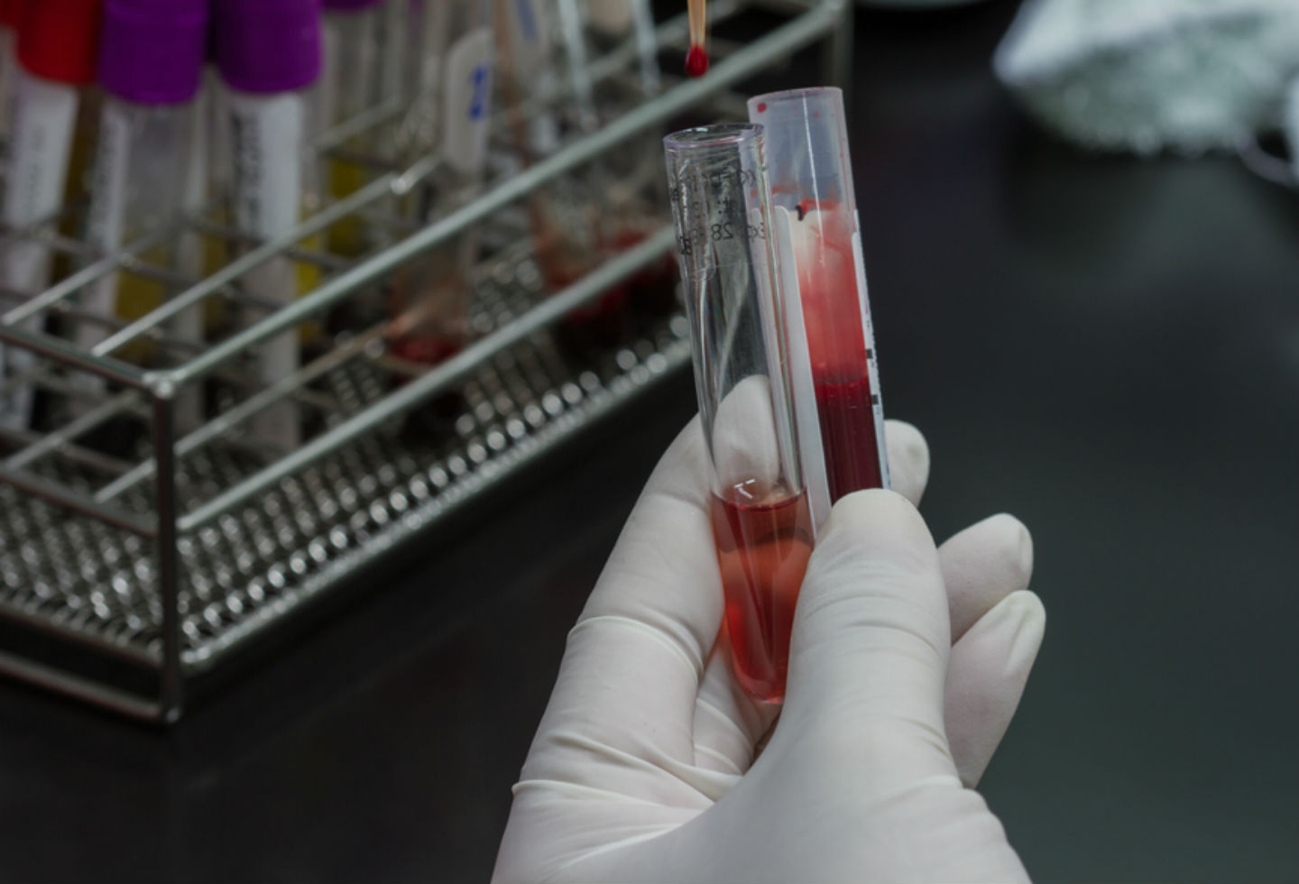 Reportan el segundo caso mundial de curación de un paciente con sida | Alerta Paisa